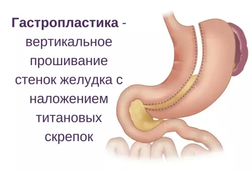 Gastroplasty vertikal