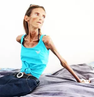 Исхрана Anorexichek.